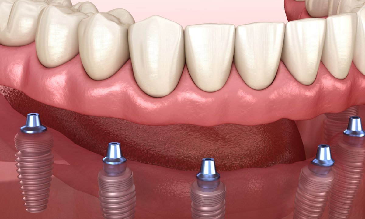 Implant-Supported Dentures | Moses Lake Implant Dentist